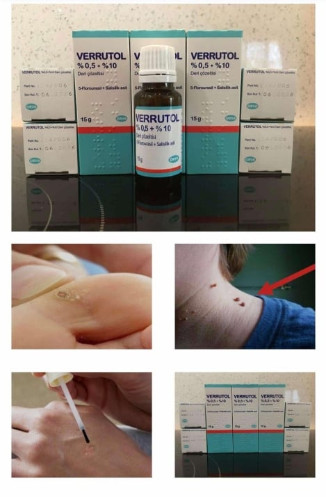 Верутол Verrutol Най-ефикасното средство за премахване на папиломи ...